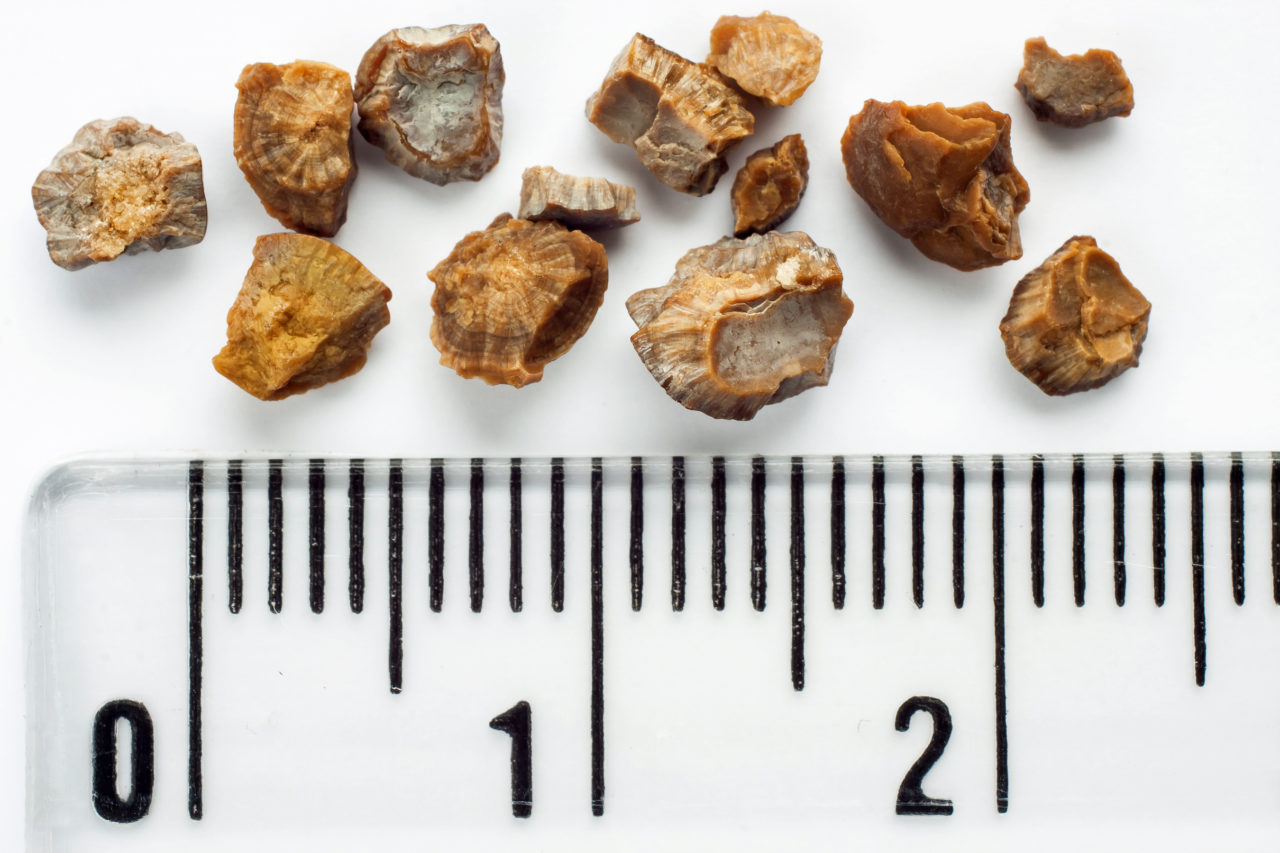 Types of Kidney Stones - Kidney Stones - Urologist - Urology Austin