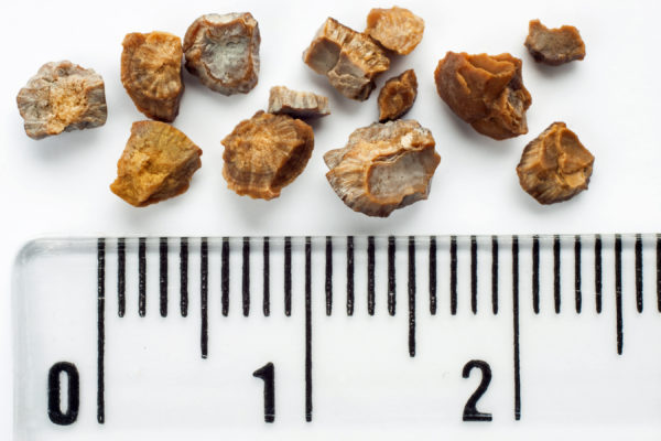 Types of Kidney Stones - Kidney Stones - Urologist - Urology Austin