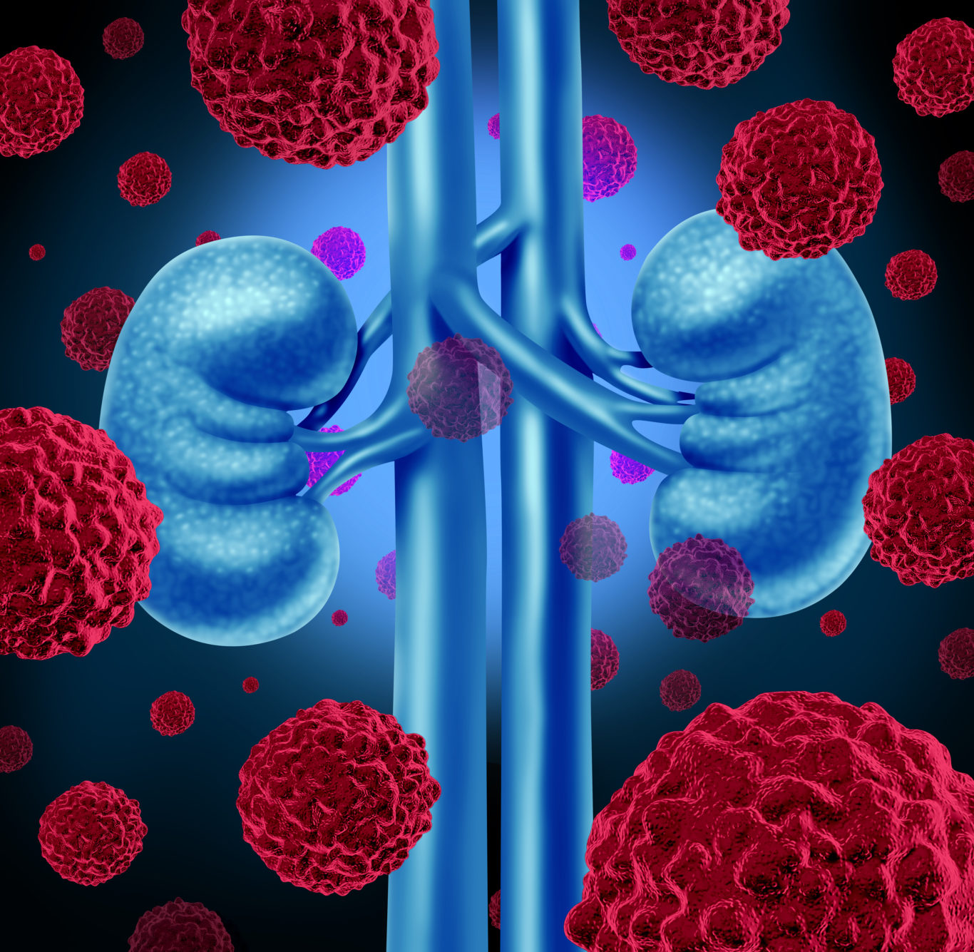 Kidney Cancer - Kidney Cancer Diagnosis -Urologist - Urology Austin