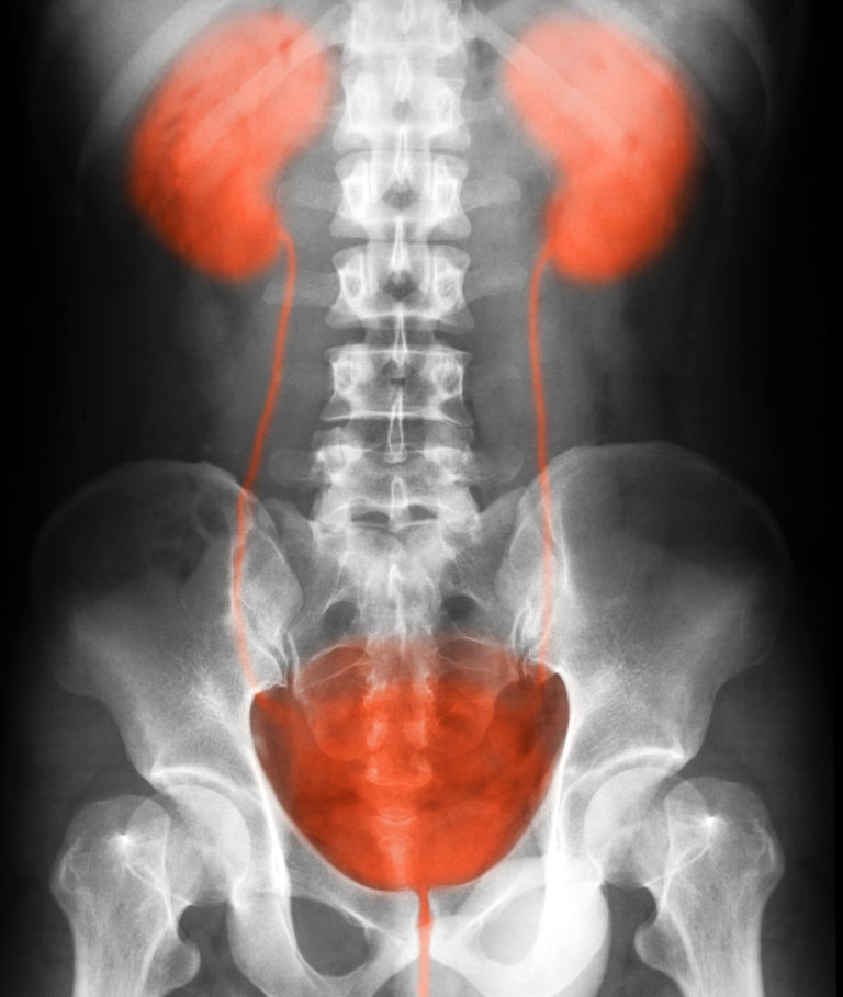 Vesicoureteral reflux - What is Vesicoureteral reflux - Urology Austin